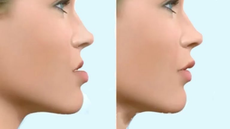 Prognatismo - Clínica Dental Dr. M. López de Calatayud