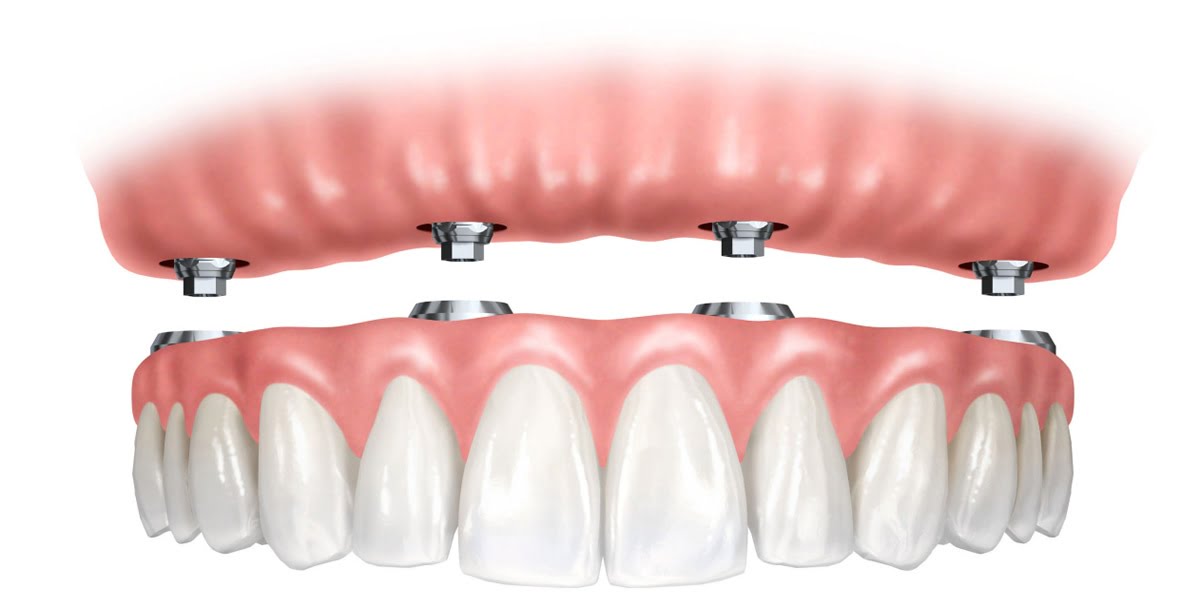 Prótesis Híbrida sobre implantes dentales - Clínica Dental Dr. M. López ...